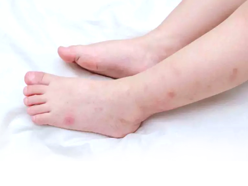 Apa Penyebab Iritasi Kulit Bayi dan Inilah Cara Mengatasinya!